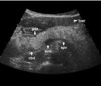 Ultrasound of the pancreas: what normal looks like | AuntMinnie