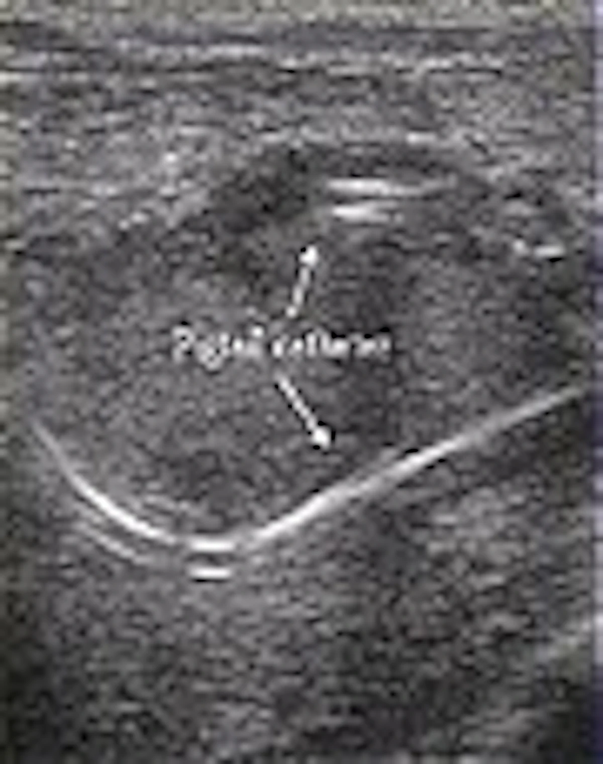 Breast abscess in lactating women resolved with ultrasound-based ...