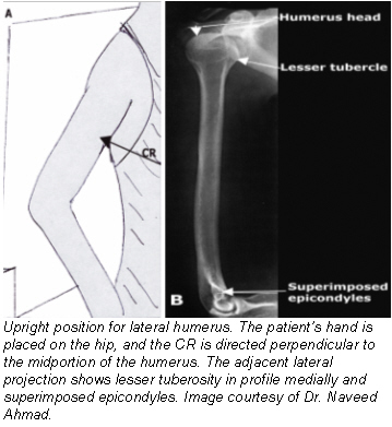Boning up on humerus, clavicle, and AC joint positioning | AuntMinnie