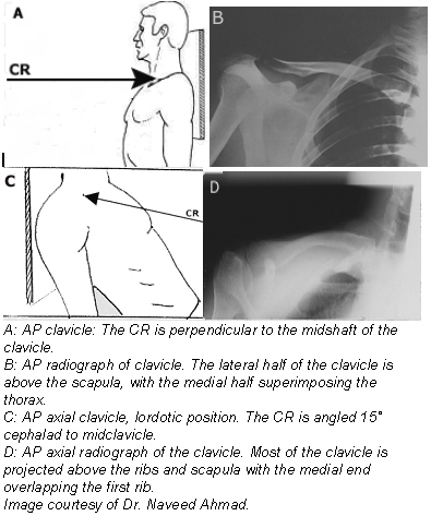 Boning up on humerus, clavicle, and AC joint positioning | AuntMinnie