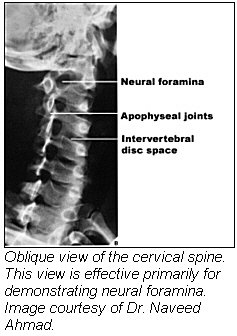 Radiographic positioning techniques for the cervical spine | AuntMinnie