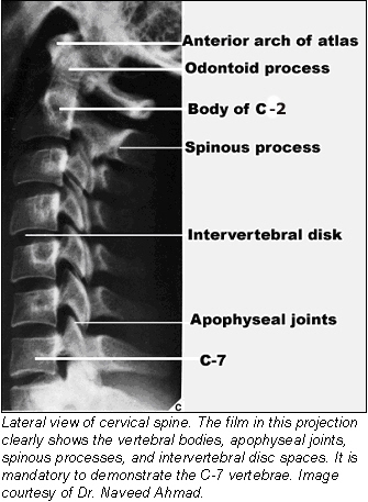 Radiographic positioning techniques for the cervical spine | AuntMinnie