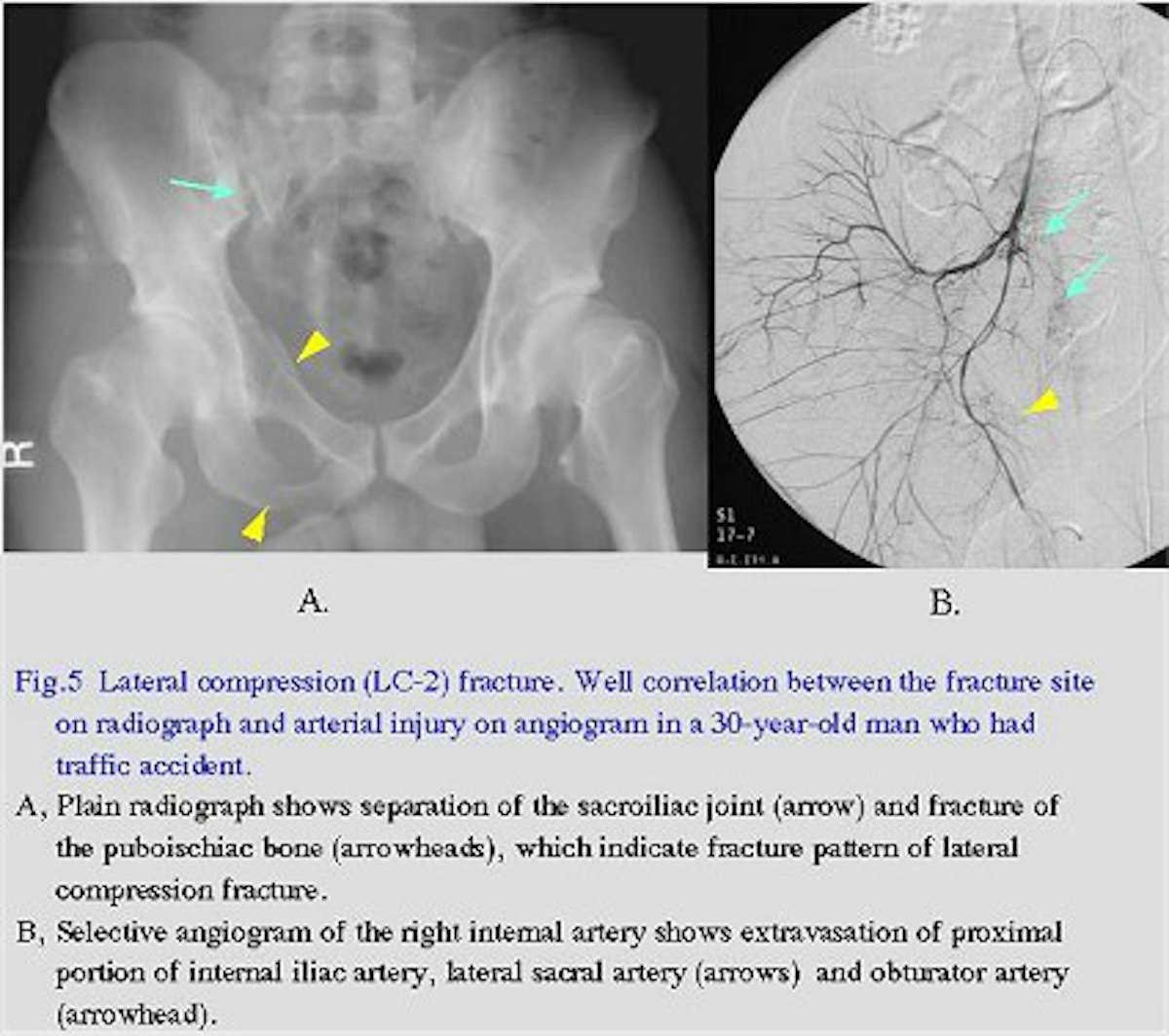 pelvic x ray interpretation