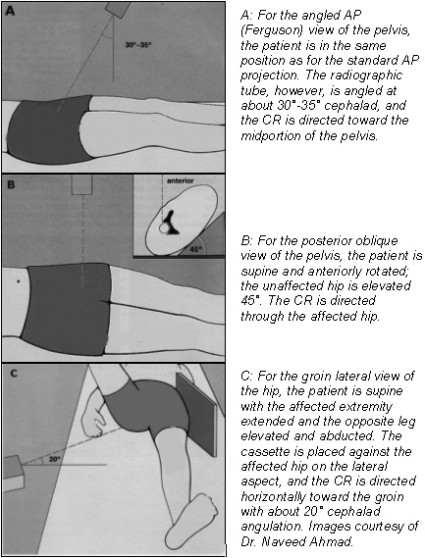 Proper positioning for the pelvis and proximal femur | AuntMinnie