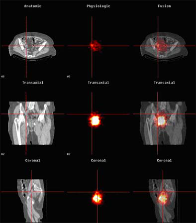 SPECT/CT improves bladder cancer staging, management | AuntMinnie