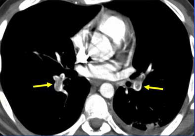 CT for PE: Best test gets better | AuntMinnie