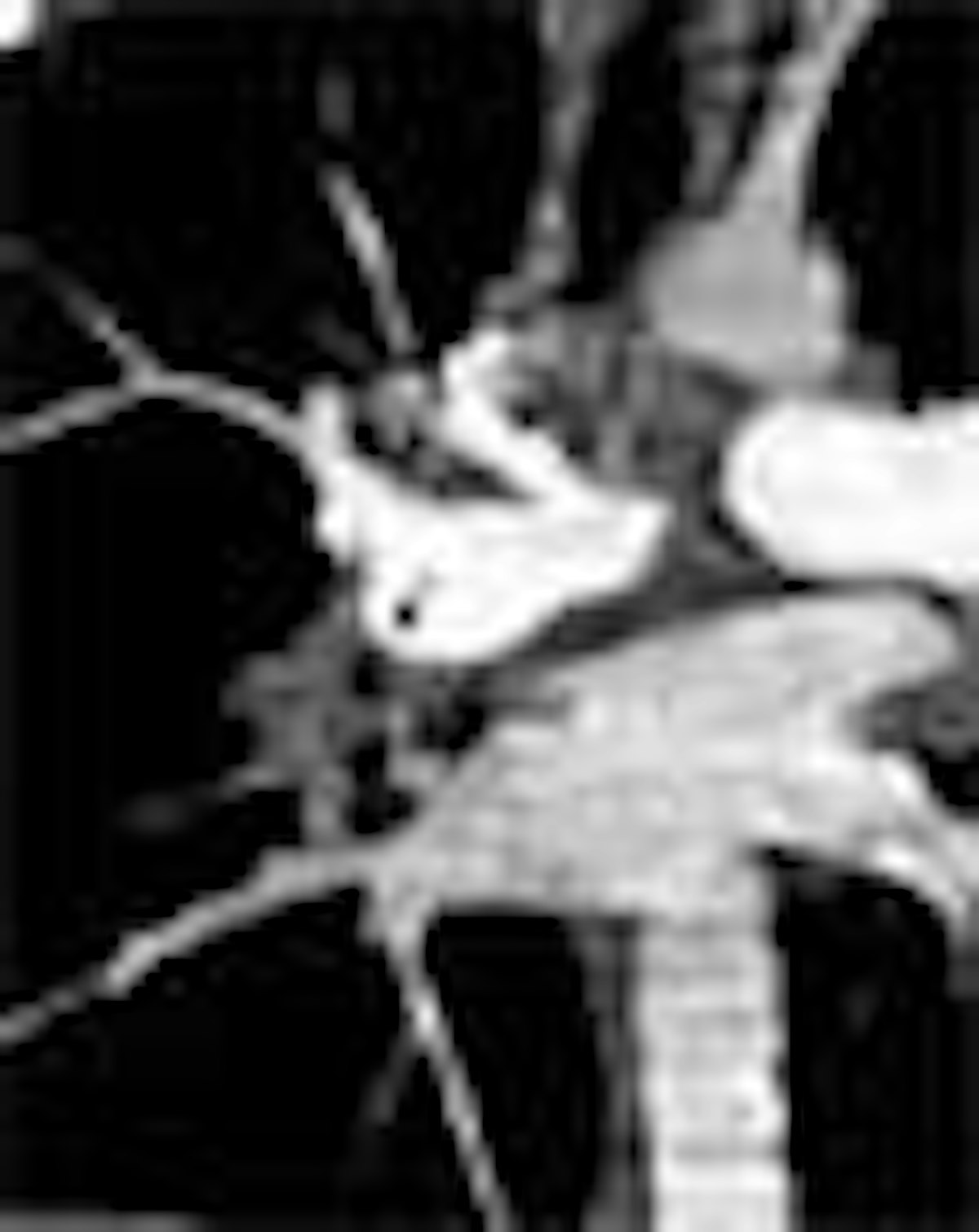 Thoracic CT expert takes on chronic PE diagnosis | AuntMinnie