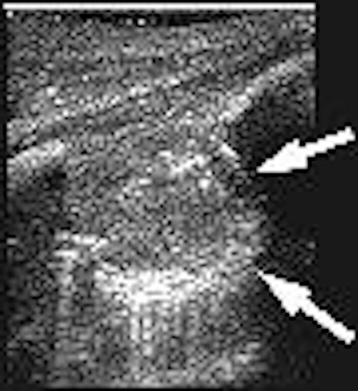Ultrasound separates fracture from metastasis in the ribs | AuntMinnie