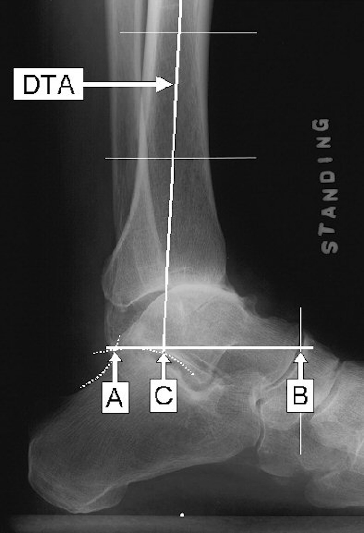 Tibial-talar ratio on x-ray reliably shows ankle alignment | AuntMinnie