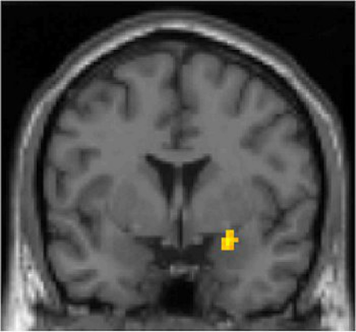 fmri amygdala