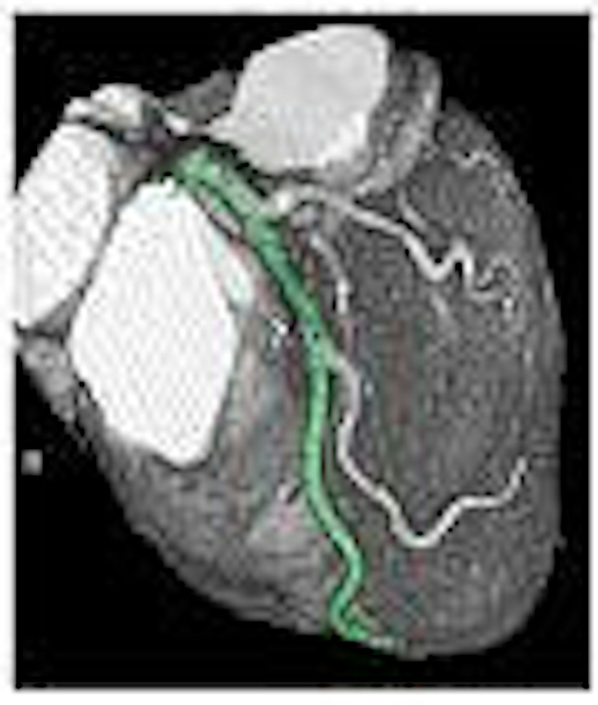 Multislice CT reveals previous plaque rupture in coronaries | AuntMinnie