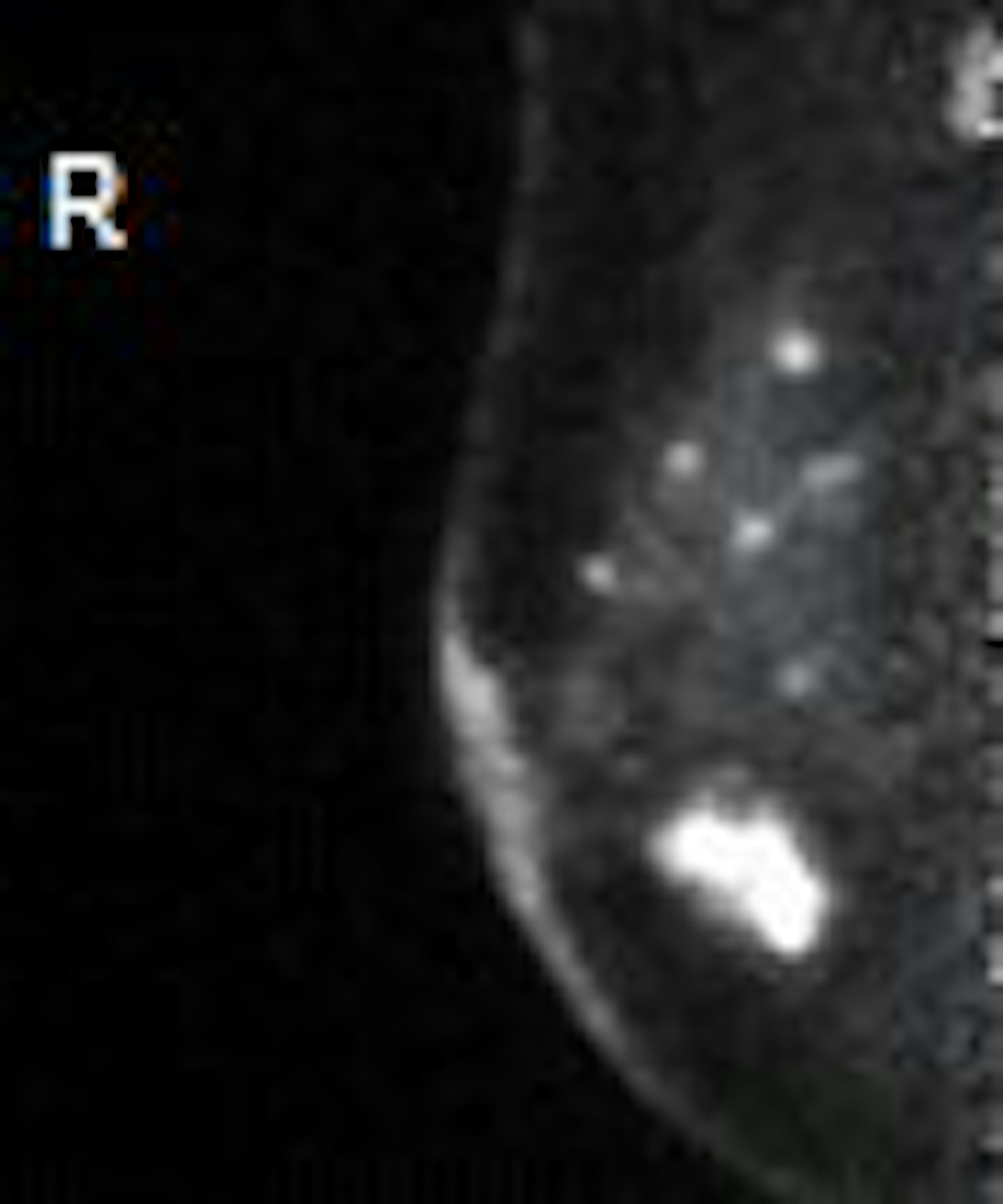 PET mammography unit shows promise for DCIS | AuntMinnie