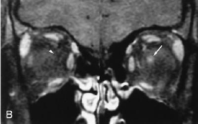 MRI distinguishes optic neuropathy due to cat scratch disease | AuntMinnie