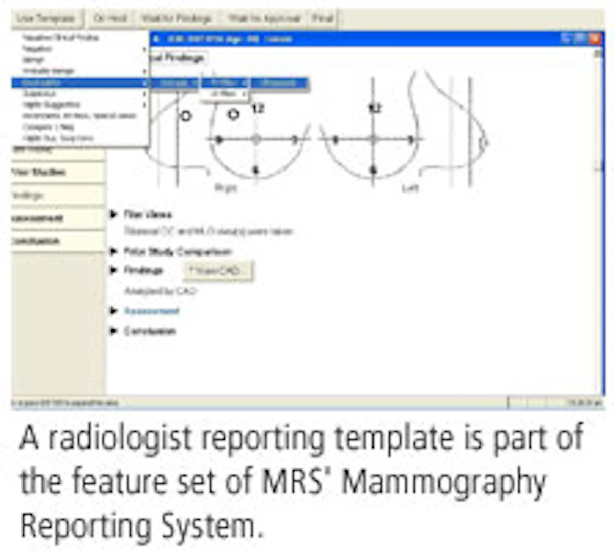 Mammography Reporting Systems | AuntMinnie