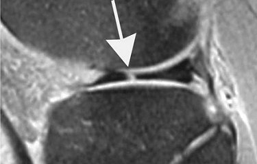 Four MRI signs diagnose radial meniscal tears preoperatively | AuntMinnie