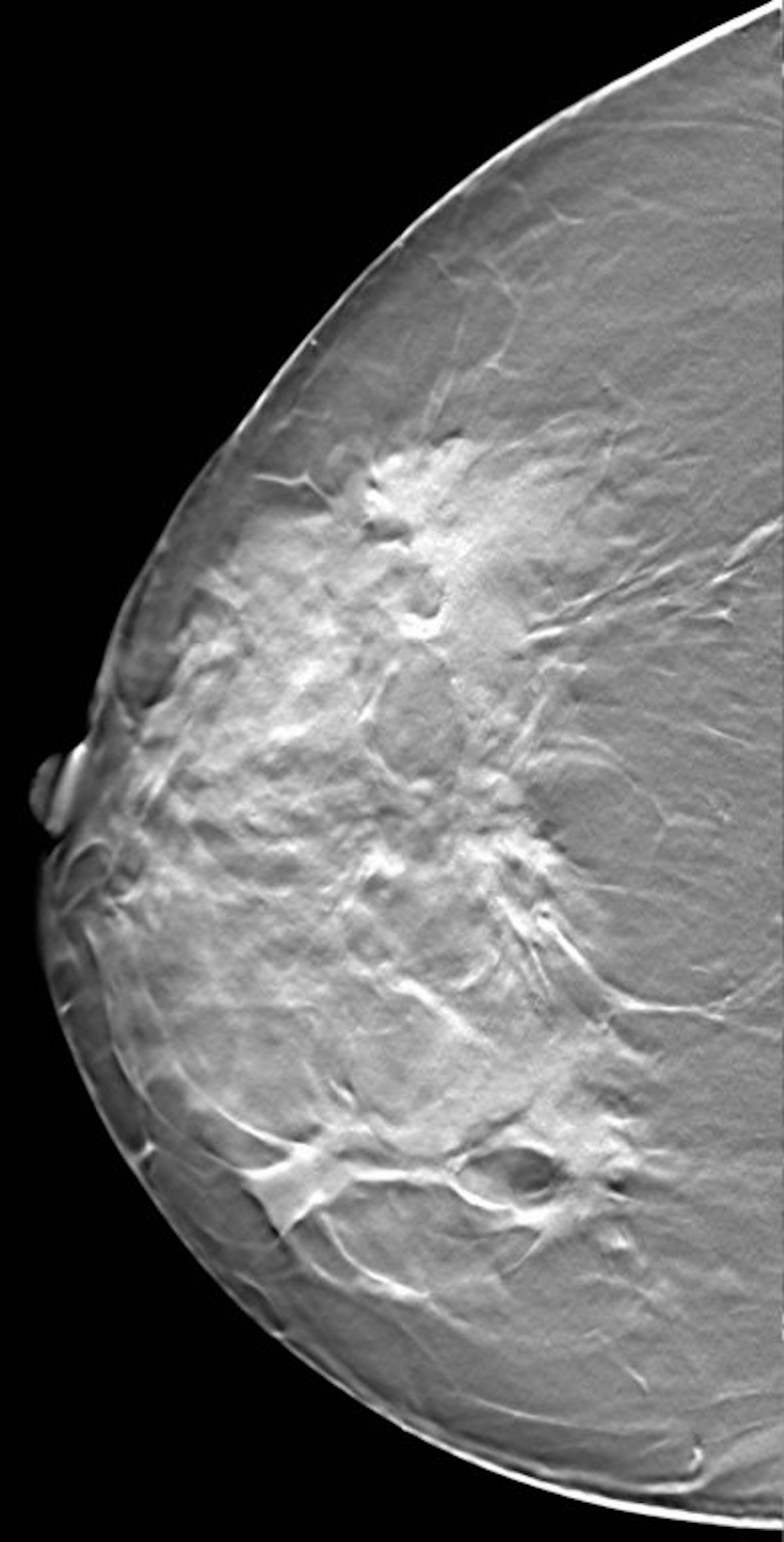 Swedish start-up XCounter pursues 3D mammography | AuntMinnie