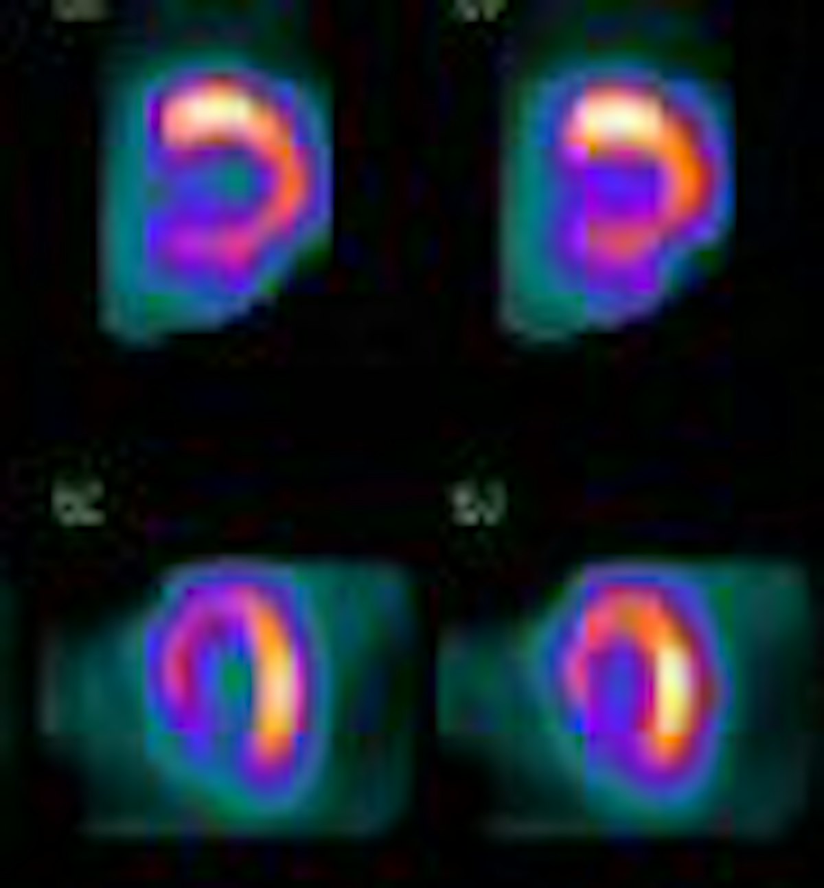 Spectrum Dynamics prepares launch of D-SPECT cardiac gamma camera ...