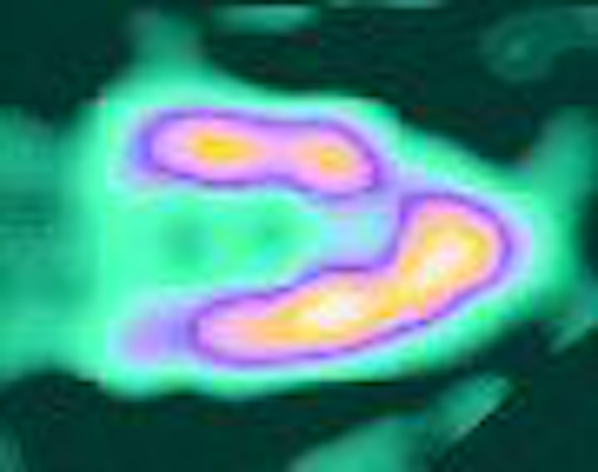 CardiArc gears up for launch of nuclear cardiology camera | AuntMinnie