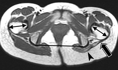 MRI of gluteal contracture backs up physical exam results | AuntMinnie