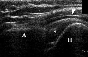 US shows full spectrum of shoulder injuries | AuntMinnie