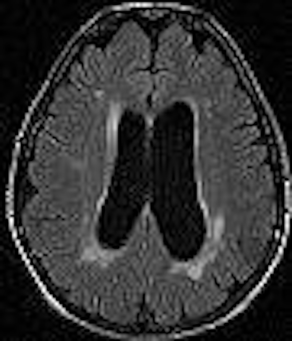 MRI traces multisystem Fabry's disease in the brain, heart, and beyond ...