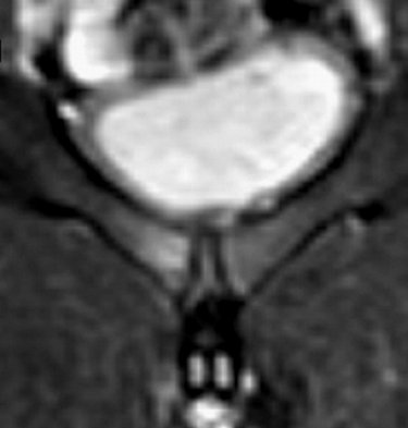 MR spots reason for chronic groin pain, but may not alter management ...