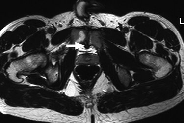 MR spots reason for chronic groin pain, but may not alter management ...