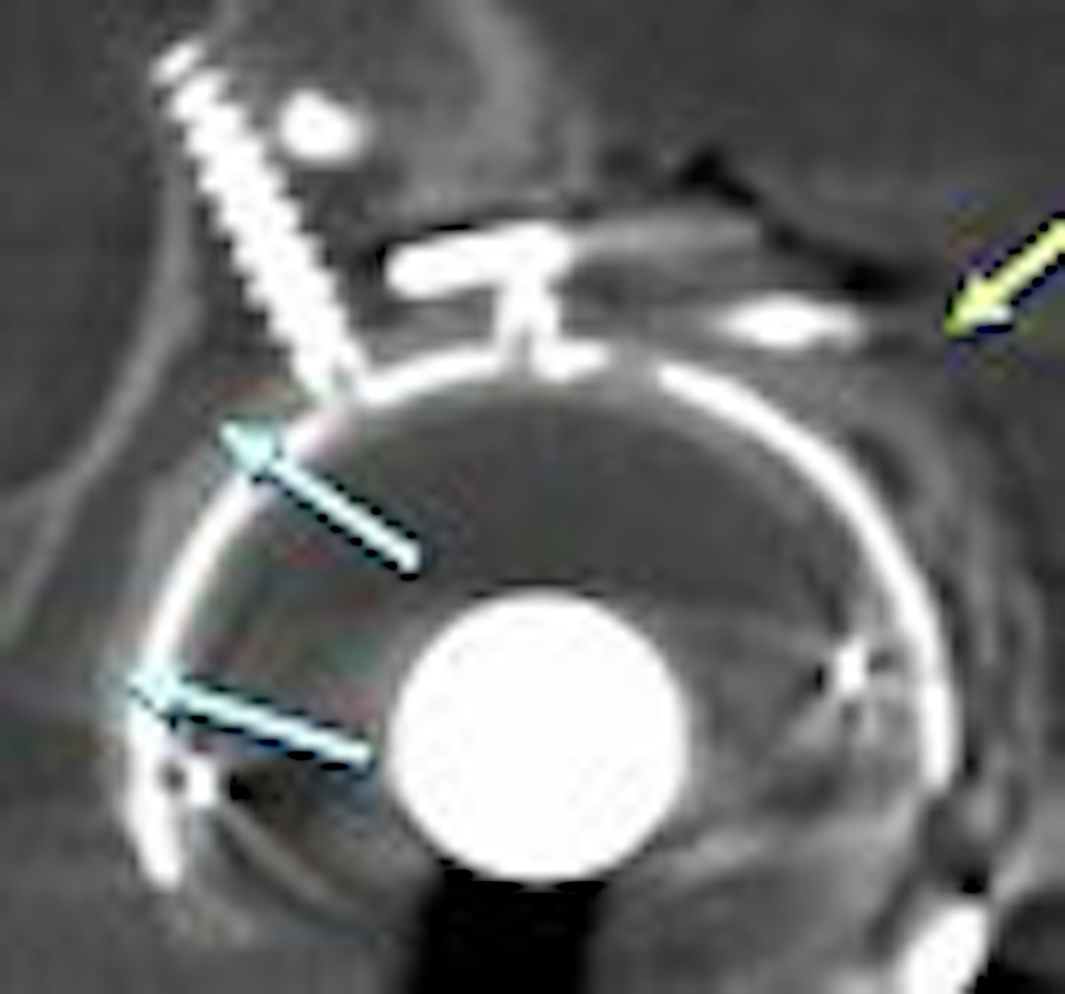 MRI, CT prove their metal for imaging orthopedic hardware | AuntMinnie