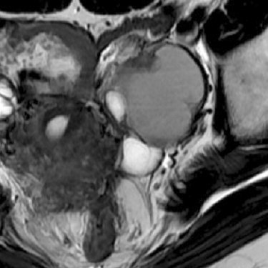 3-tesla MRI sheds light on shading sign in endometriosis | AuntMinnie