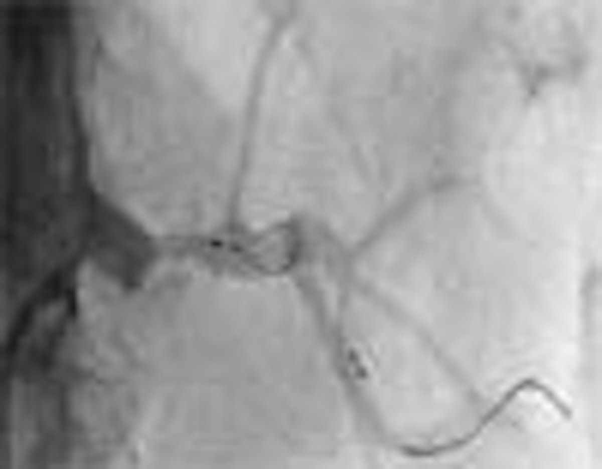 Renal artery size varies widely; stent filters don't fit | AuntMinnie