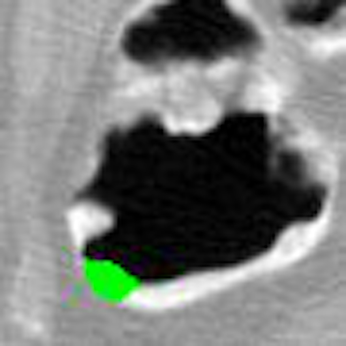 Fully automated VC CAD system solves tagging problems | AuntMinnie