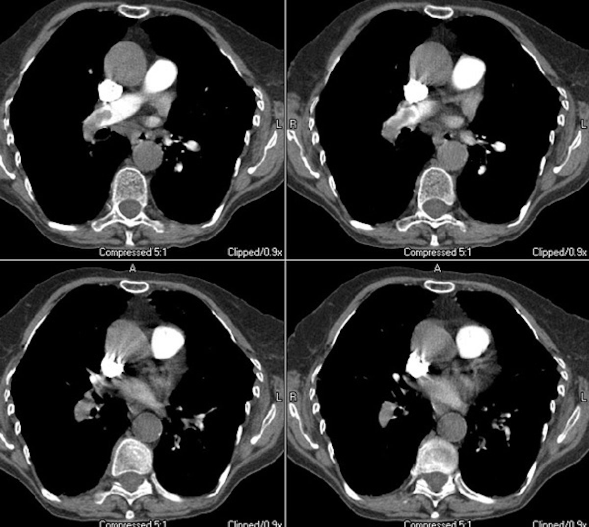 Vascular > PE > Images > Right heart strain | AuntMinnie