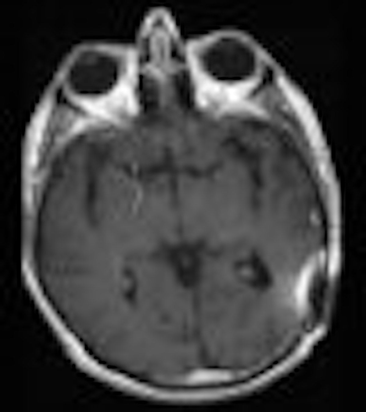 Isotope shows promise in brain cancer treatment | AuntMinnie