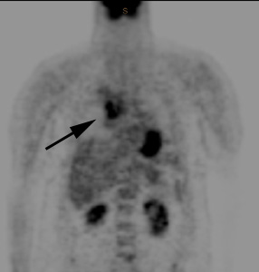 Misc > Atelectasis > Images > Golden S sign | AuntMinnie