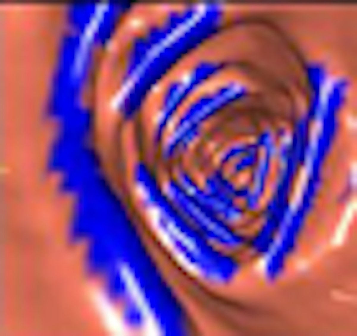Haustral fold analysis may aid detection of flat colorectal polyps ...