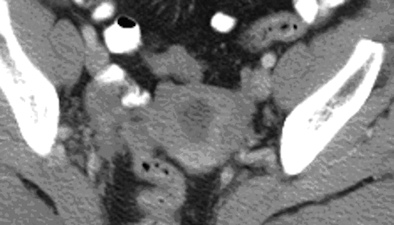 CT yields low sensitivity for endometrial thickening | AuntMinnie