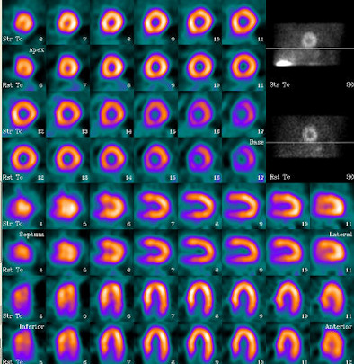 Ultrafast cardiac camera comparable to standard SPECT | AuntMinnie