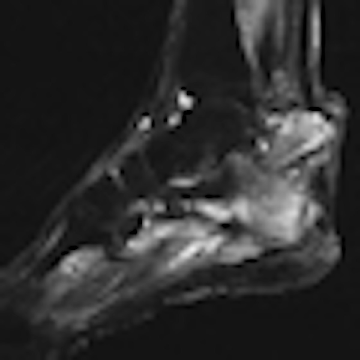 MRI shows prowess in diabetic foot with osteomyelitis | AuntMinnie