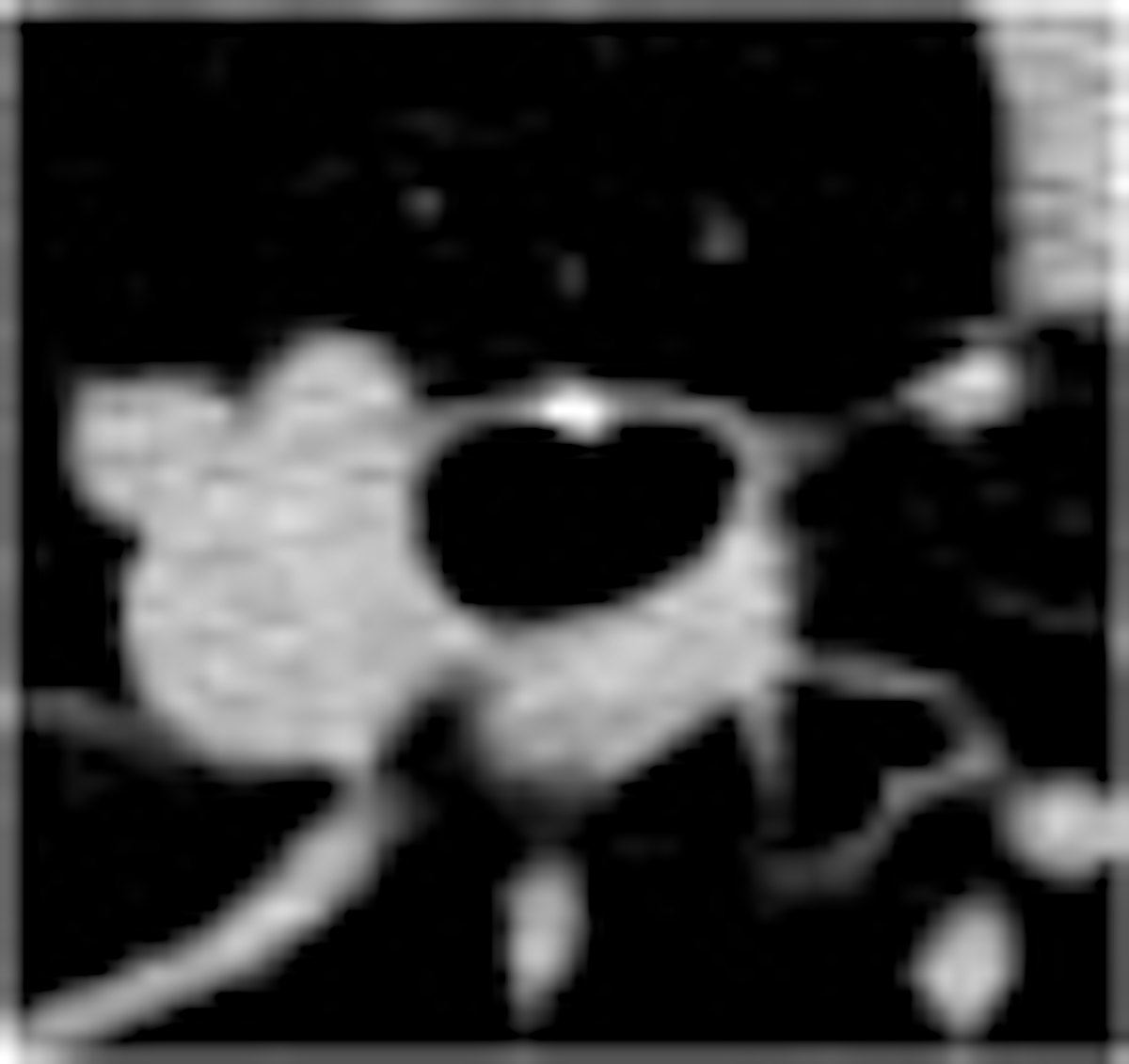 New CT method measures airway calcium to predict lung cancer | AuntMinnie
