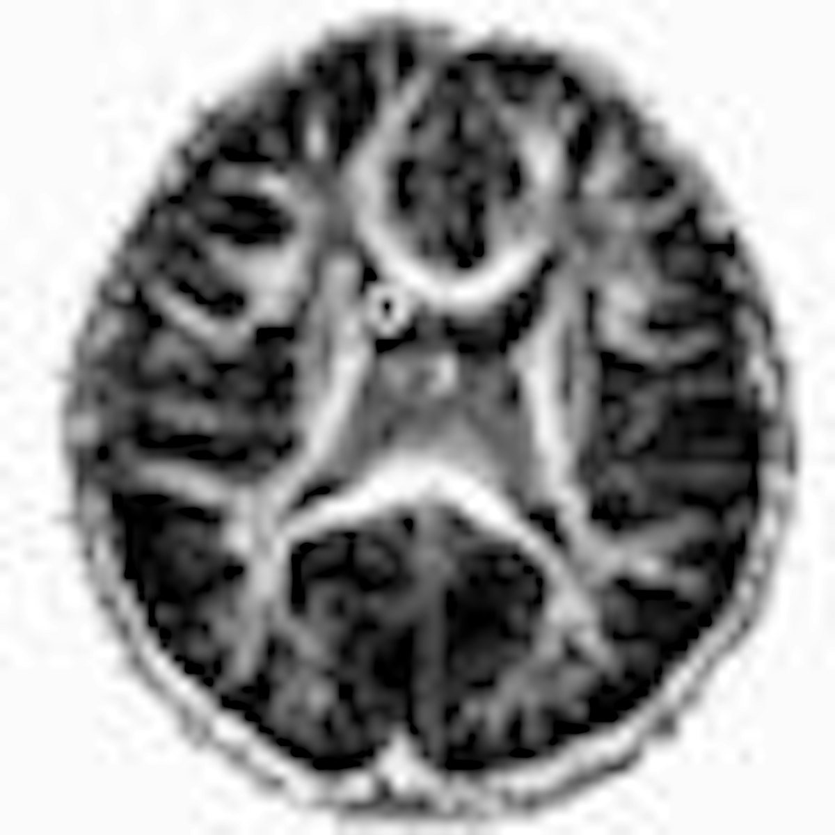 MRI shows abnormal brain development from prenatal meth exposure ...