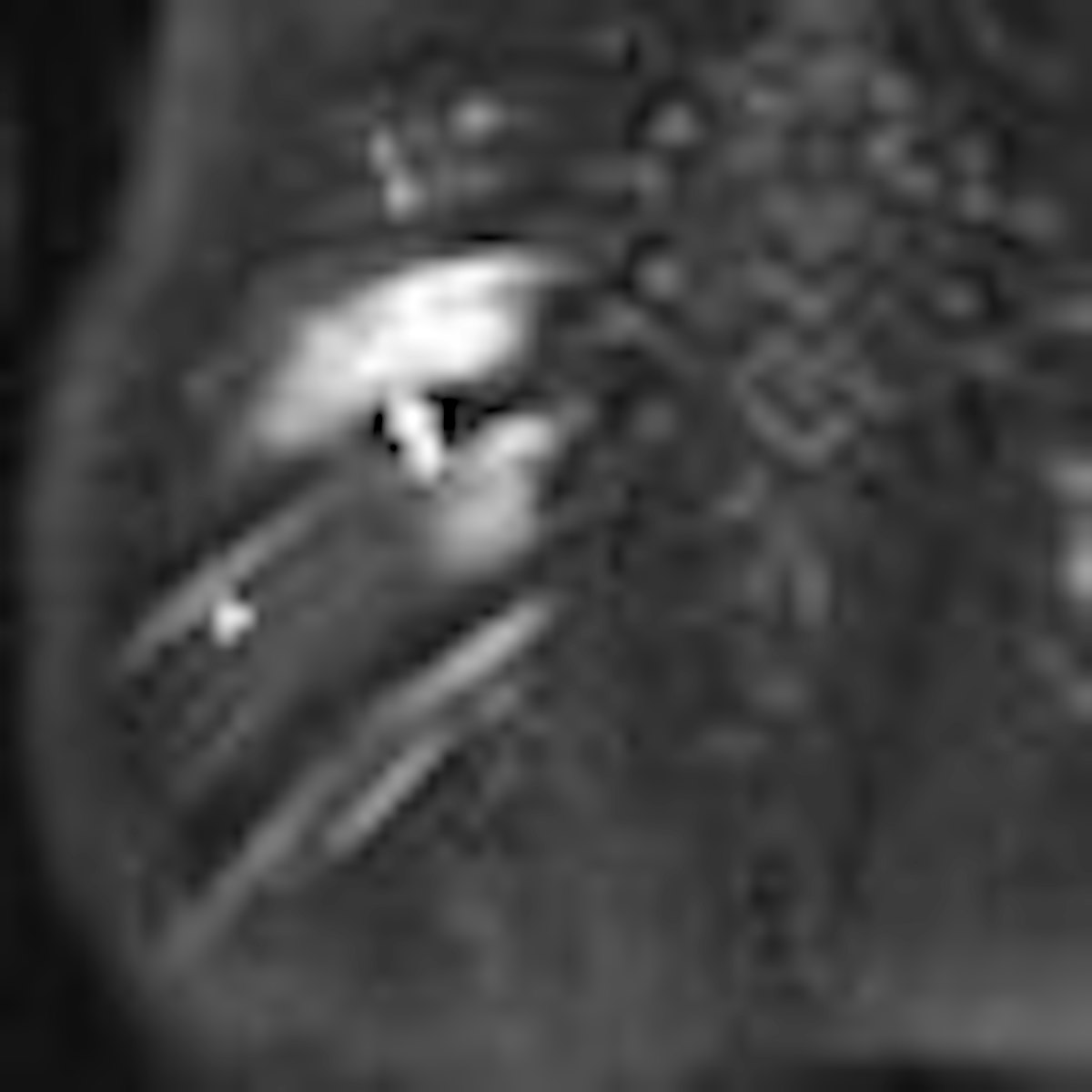 MRI with STIR fails to change diagnosis in child abuse cases | AuntMinnie