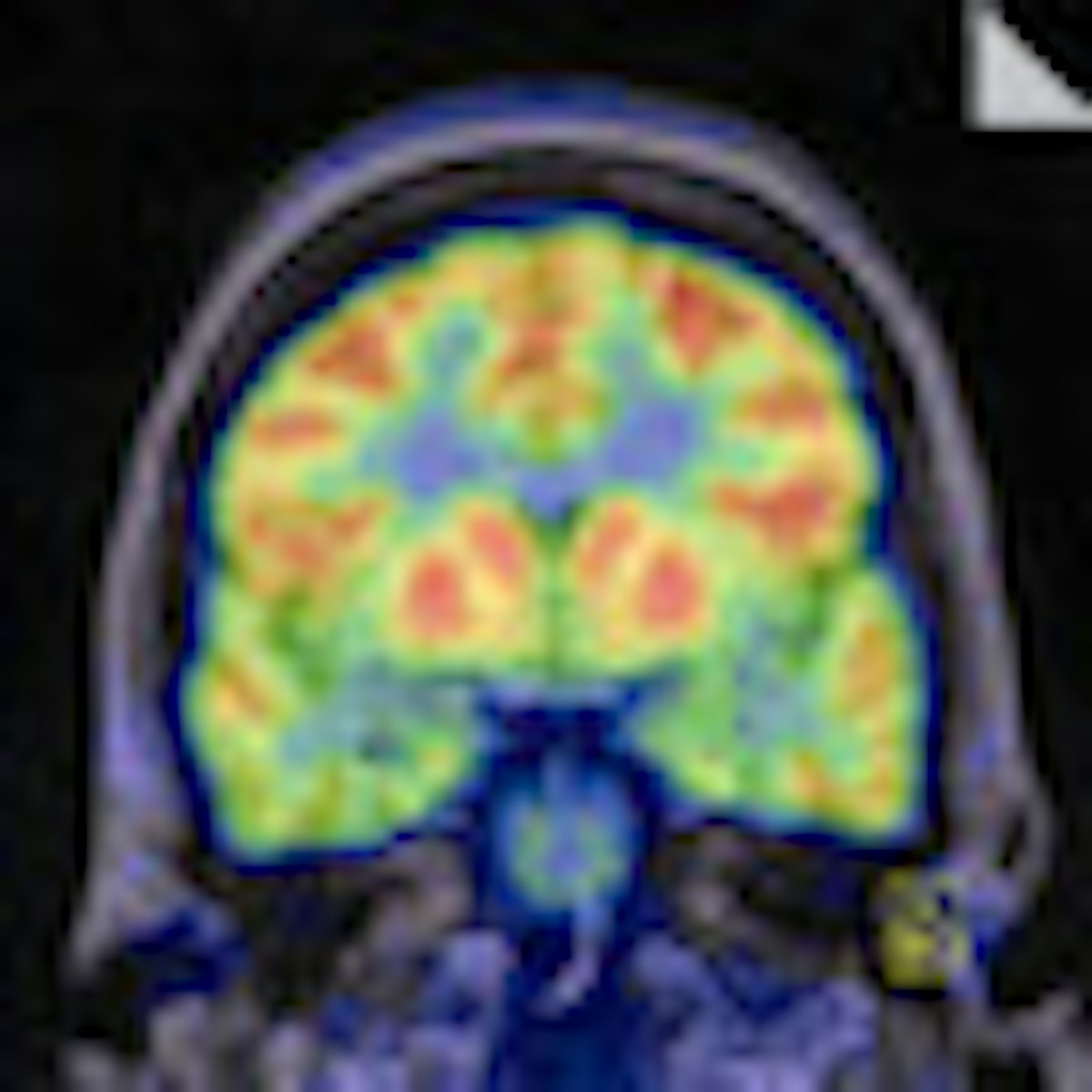 Second PET scan can spot seizure origin in epilepsy patients | AuntMinnie