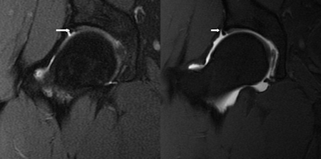 3T MRI as good as MR arthrography for planning hip surgery | AuntMinnie