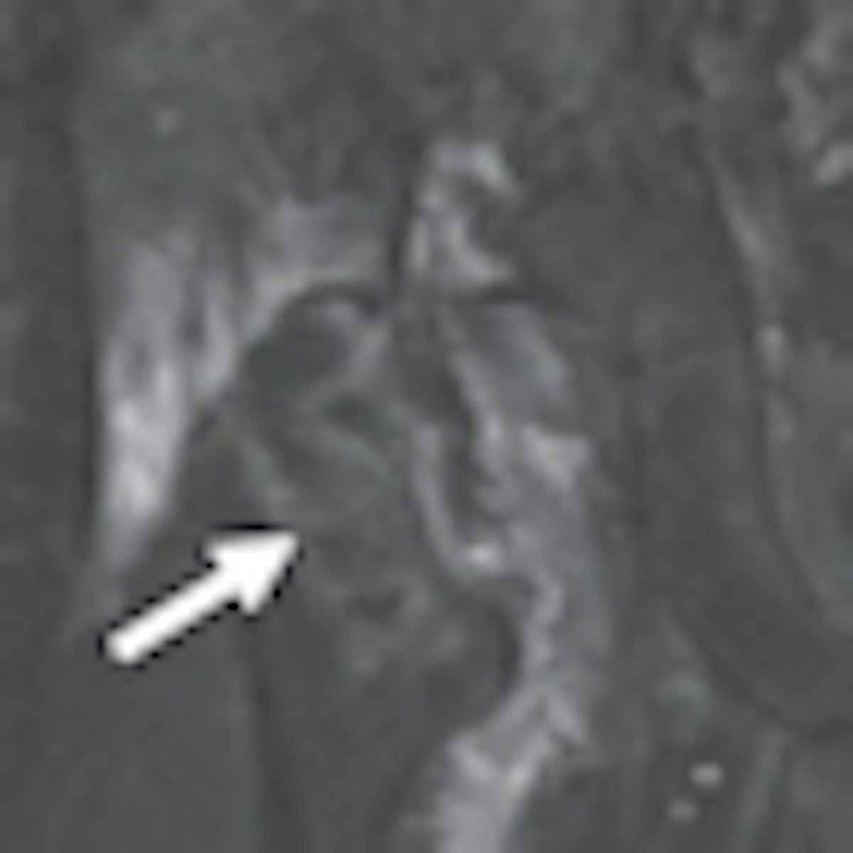 MRI finds fractures missed by x-ray among elderly ER patients | AuntMinnie