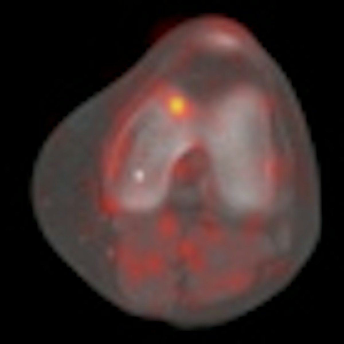 F-18 NaF PET/CT helps detect source of patellofemoral knee pain ...