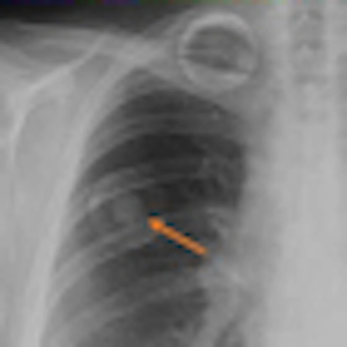 Chest x-ray CAD offers value in detecting lung cancers | AuntMinnie
