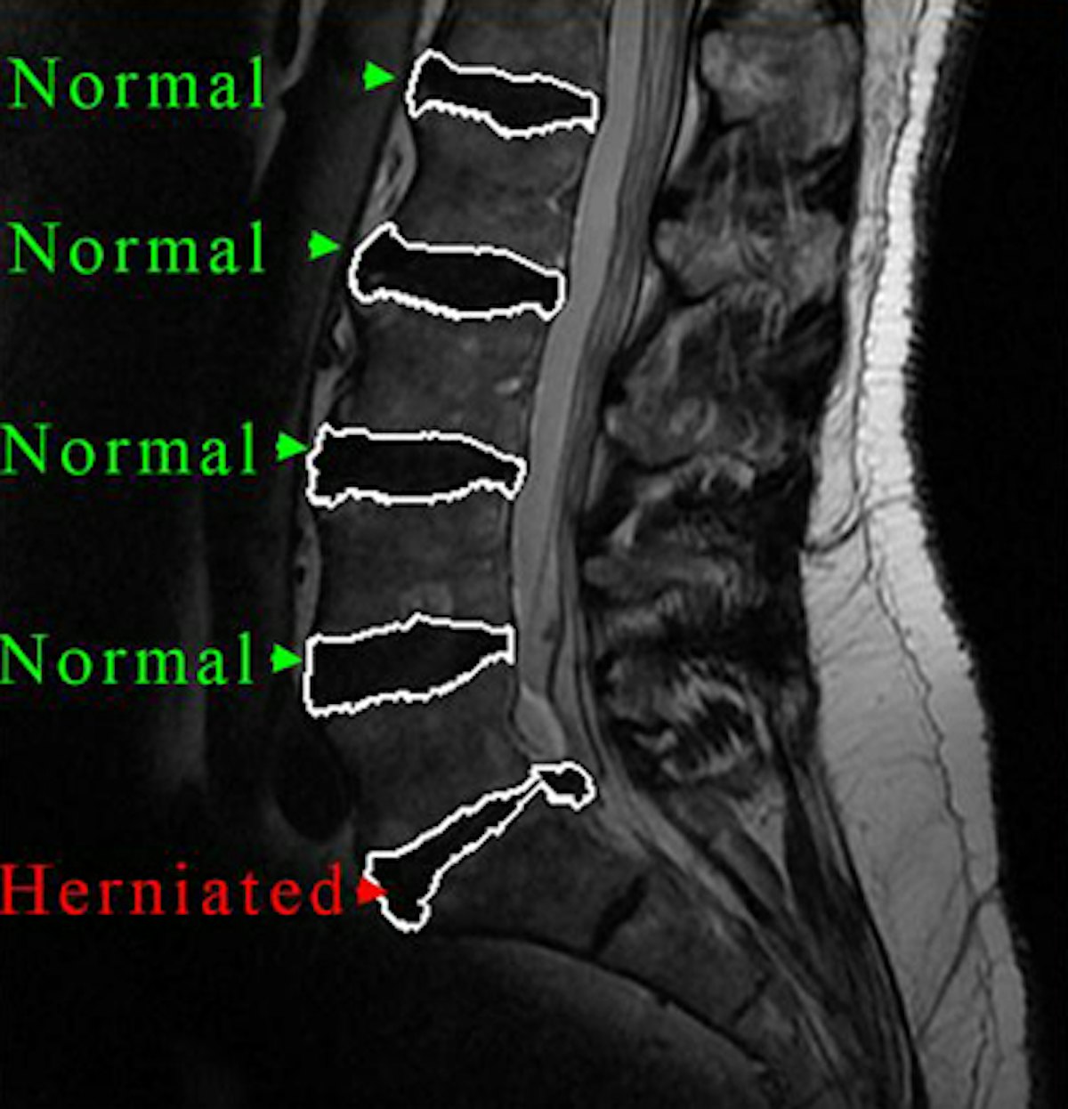mri scan herniated disc