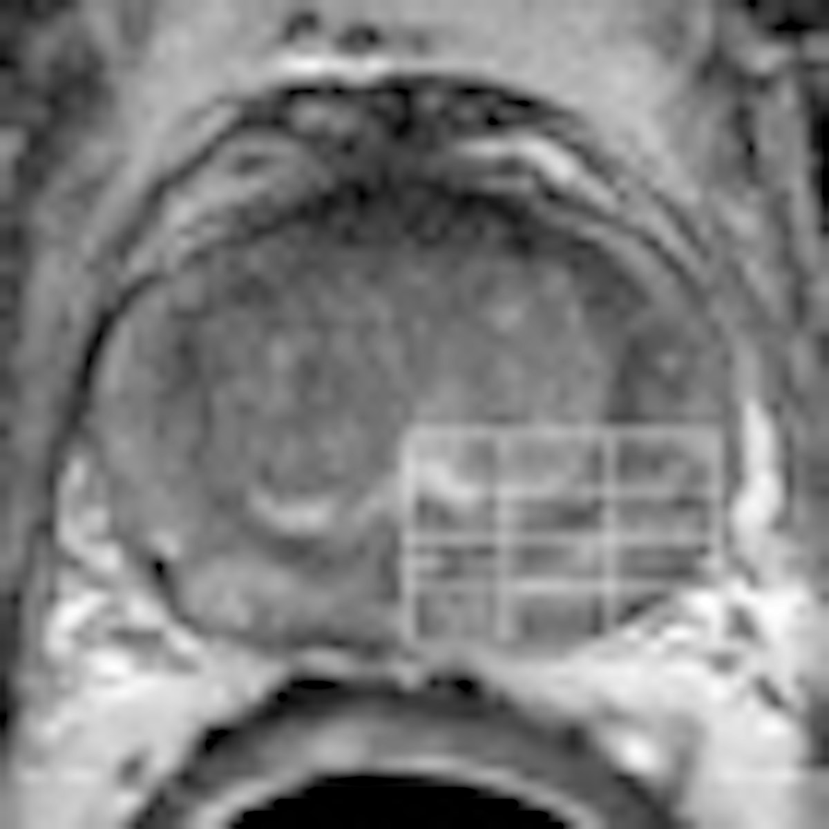 MR spectroscopy with MRI detects prostate cancer recurrence | AuntMinnie