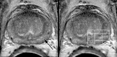 MR spectroscopy with MRI detects prostate cancer recurrence | AuntMinnie
