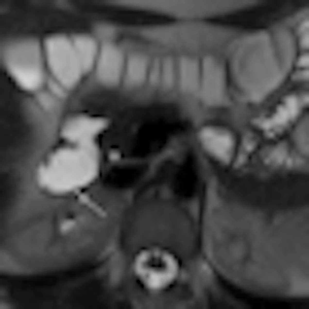 Contrast MRI visualizes bowel damage caused by celiac disease | AuntMinnie